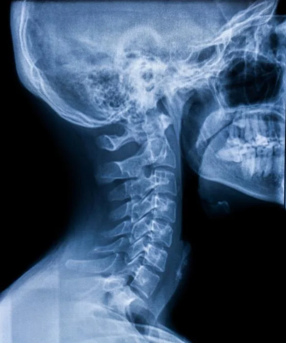 Broken Back X Ray Human